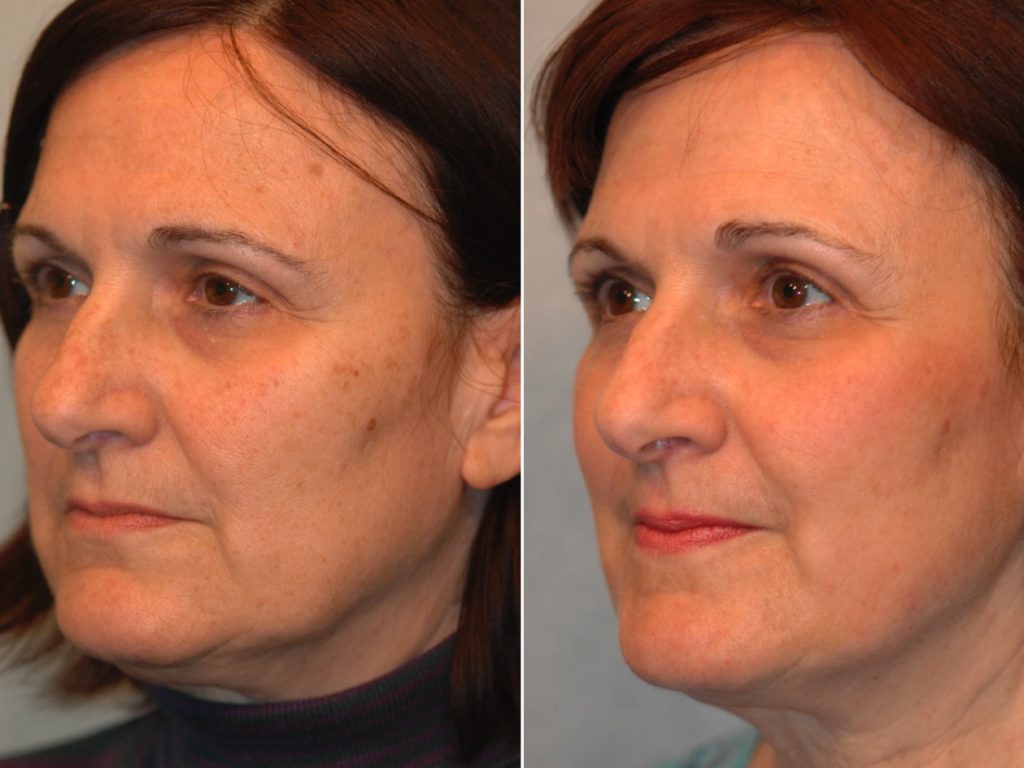 Get Gorgeous Glowing Skin with Pearl Rejuvenation! - Dr. Shel Wellness ...